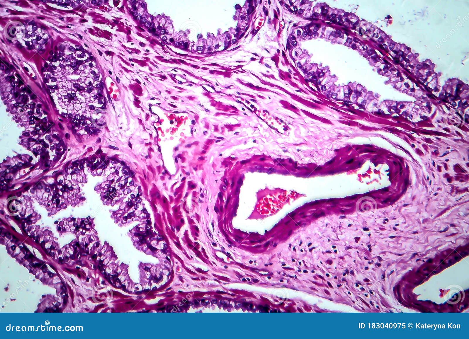 Prostate Cancer, Light Micrograph Stock Image - Image of medical ...