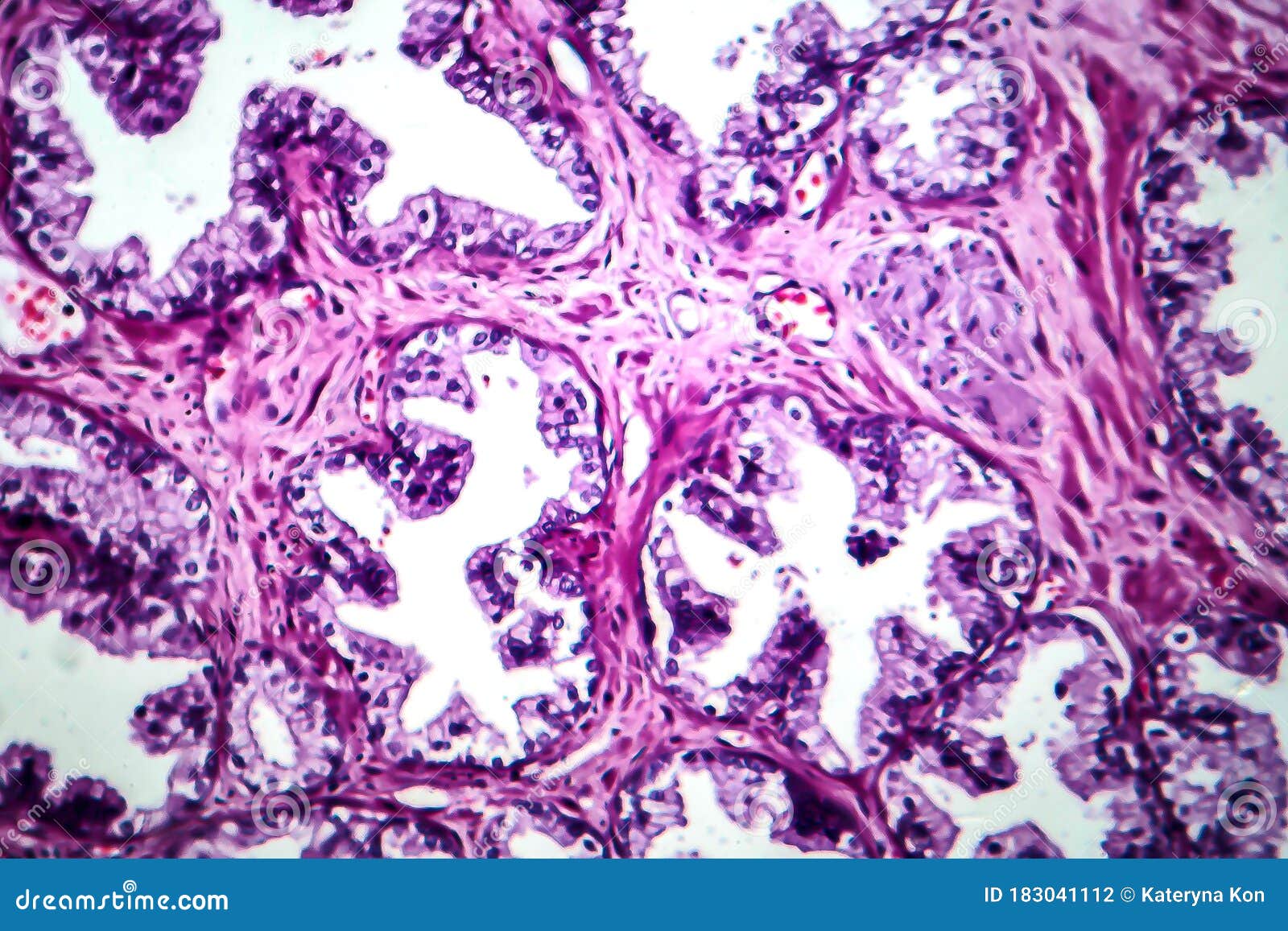 Prostate Cancer, Light Micrograph Stock Photo - Image of tissue ...