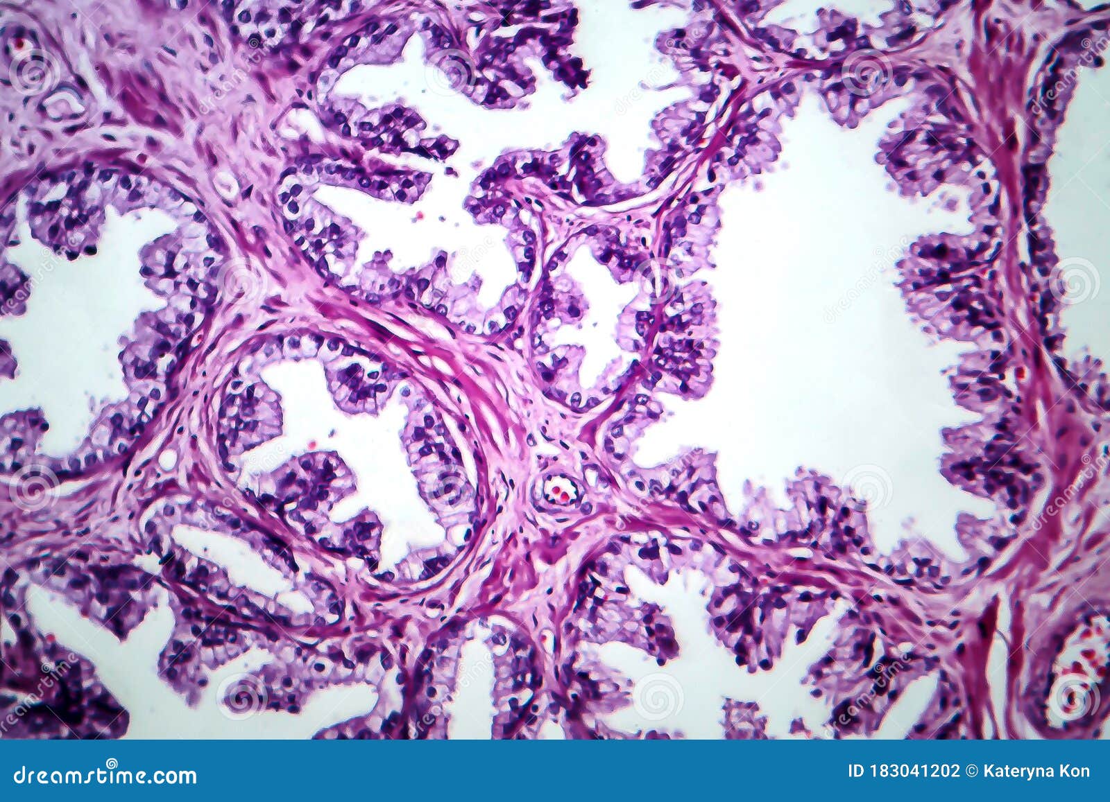 Prostate Cancer, Light Micrograph Stock Photo - Image of micrograph ...