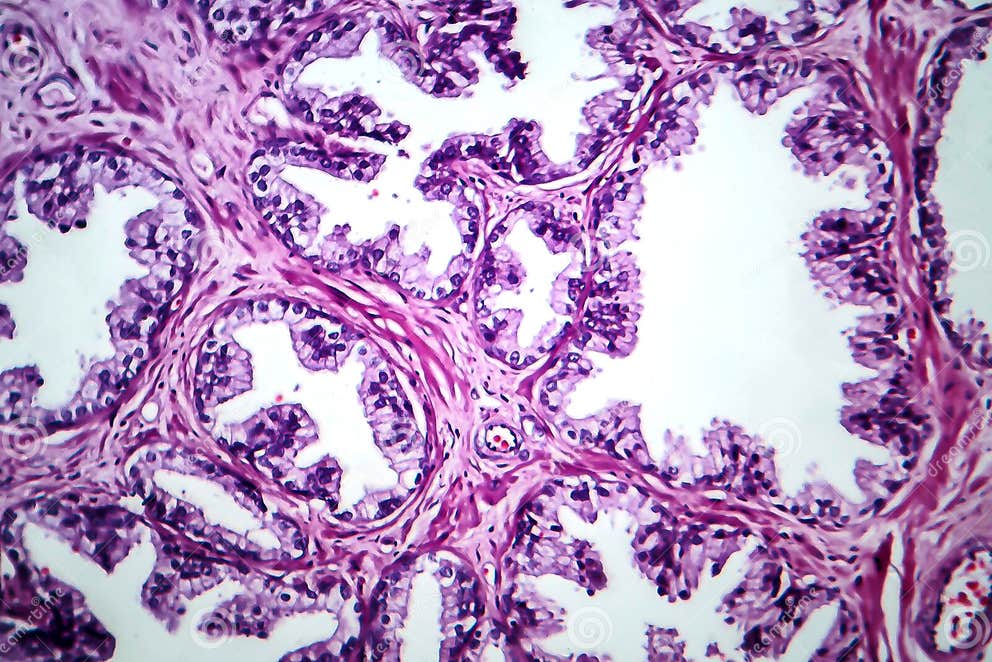 Prostate Cancer, Light Micrograph Stock Photo - Image of micrograph ...
