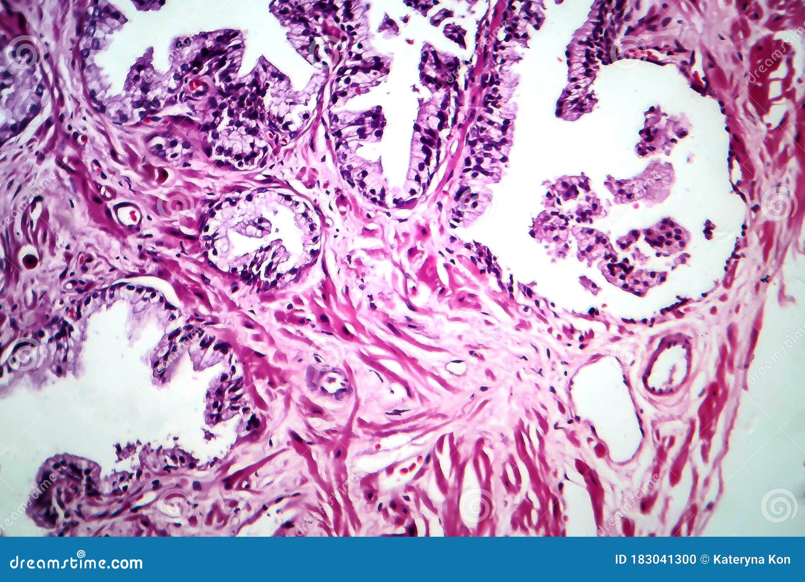 Prostate Cancer, Light Micrograph Stock Photo - Image of stain, male ...