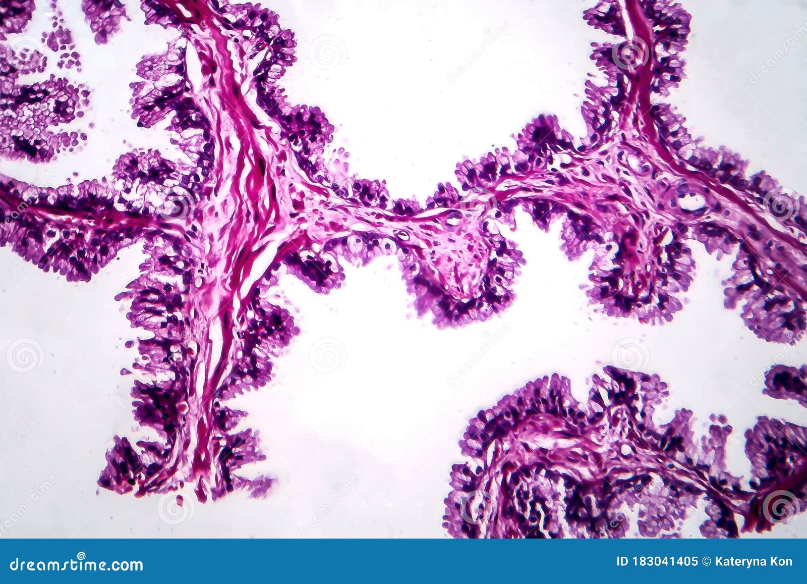 Prostate Cancer, Light Micrograph Stock Image - Image of microscopy ...