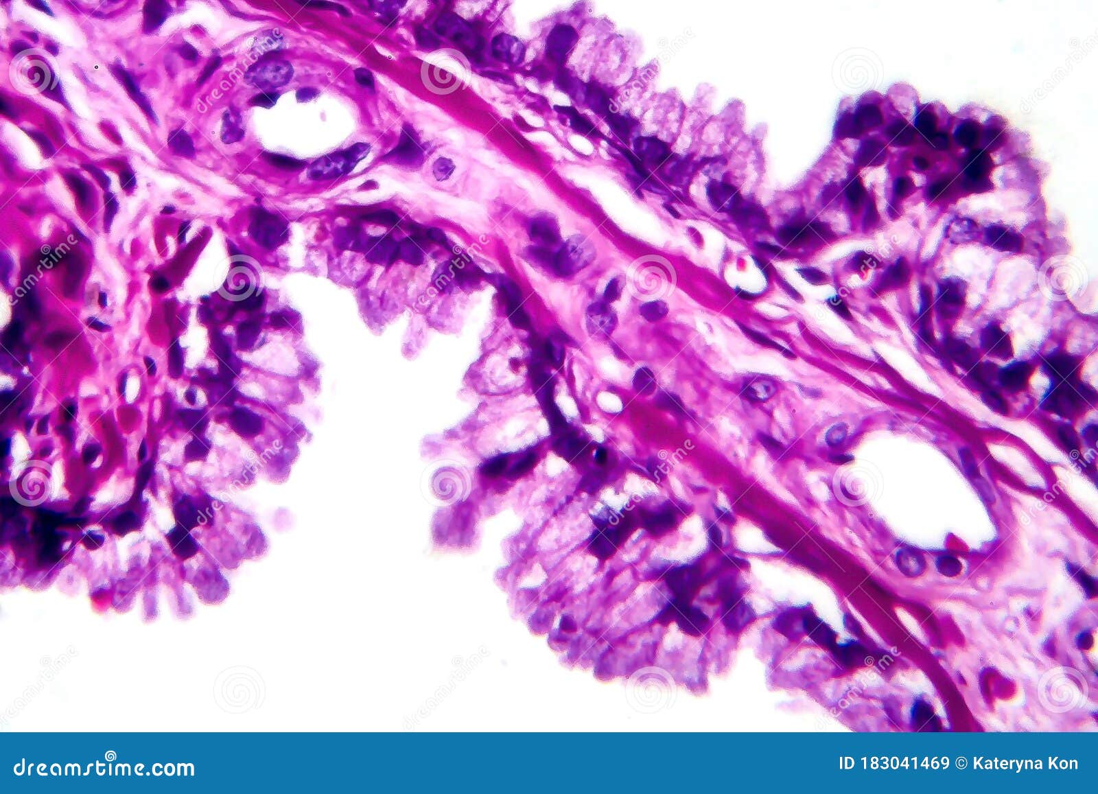Prostate Cancer, Light Micrograph Stock Image - Image of microscopic ...