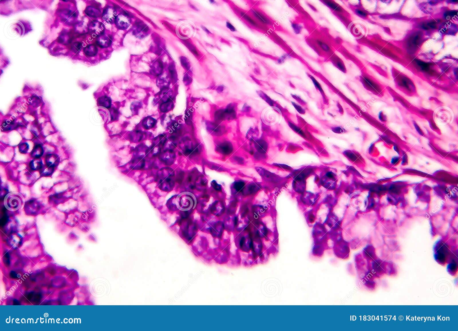Prostate Cancer, Light Micrograph Stock Photo - Image of prostate ...