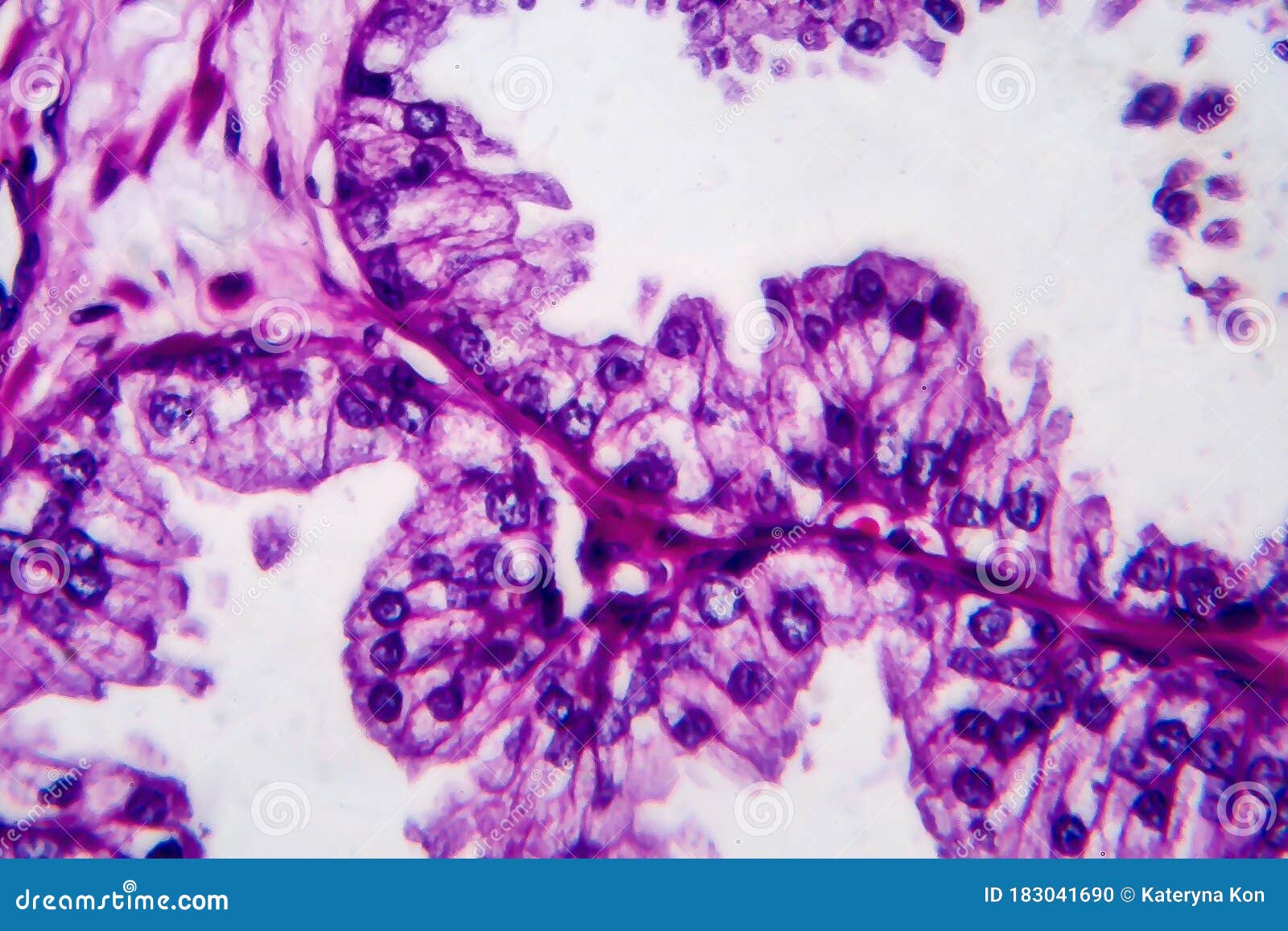 Prostate Cancer, Light Micrograph Stock Photo - Image of disease ...