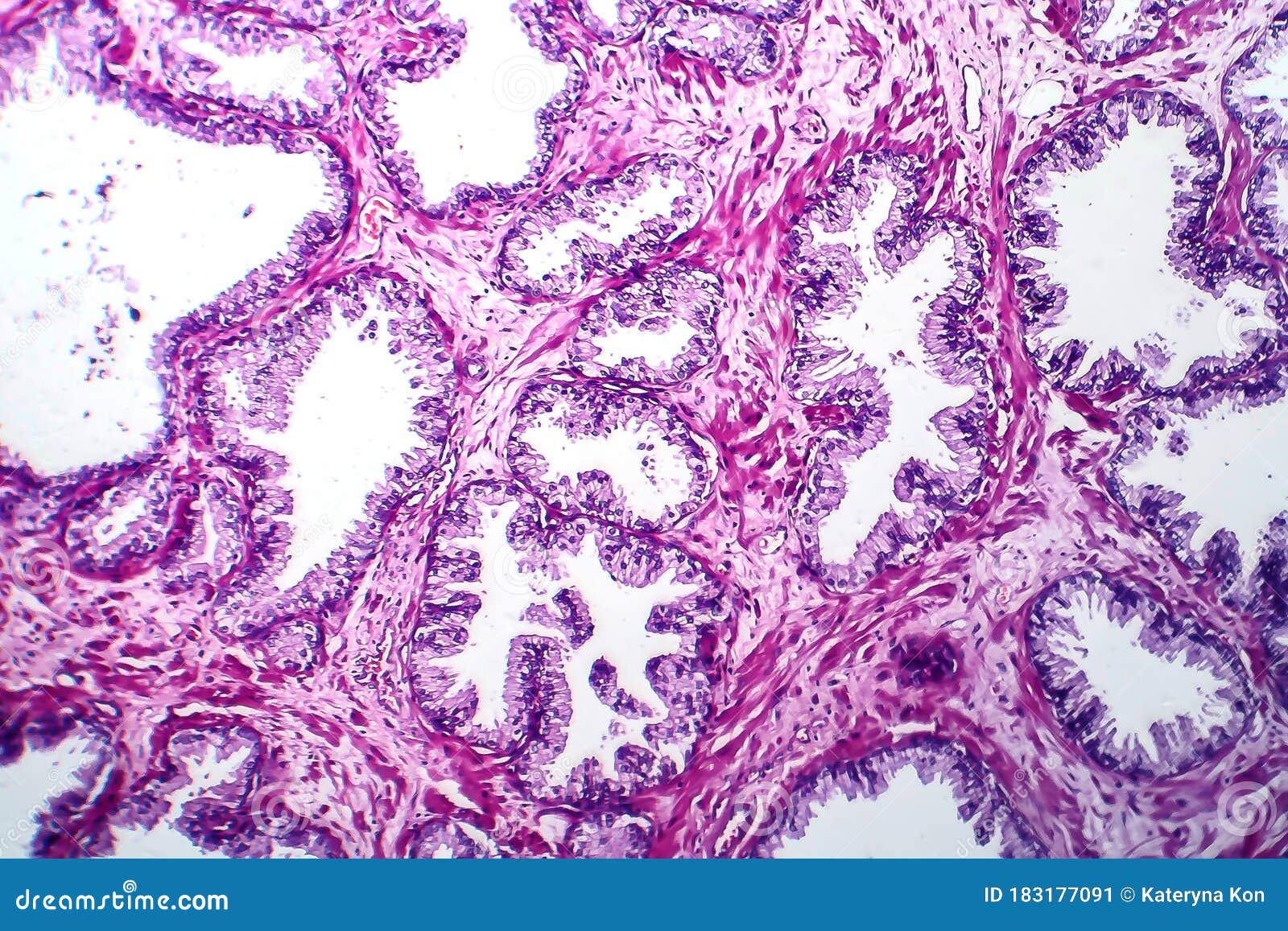 Prostate Cancer, Light Micrograph Stock Image - Image of pathology ...