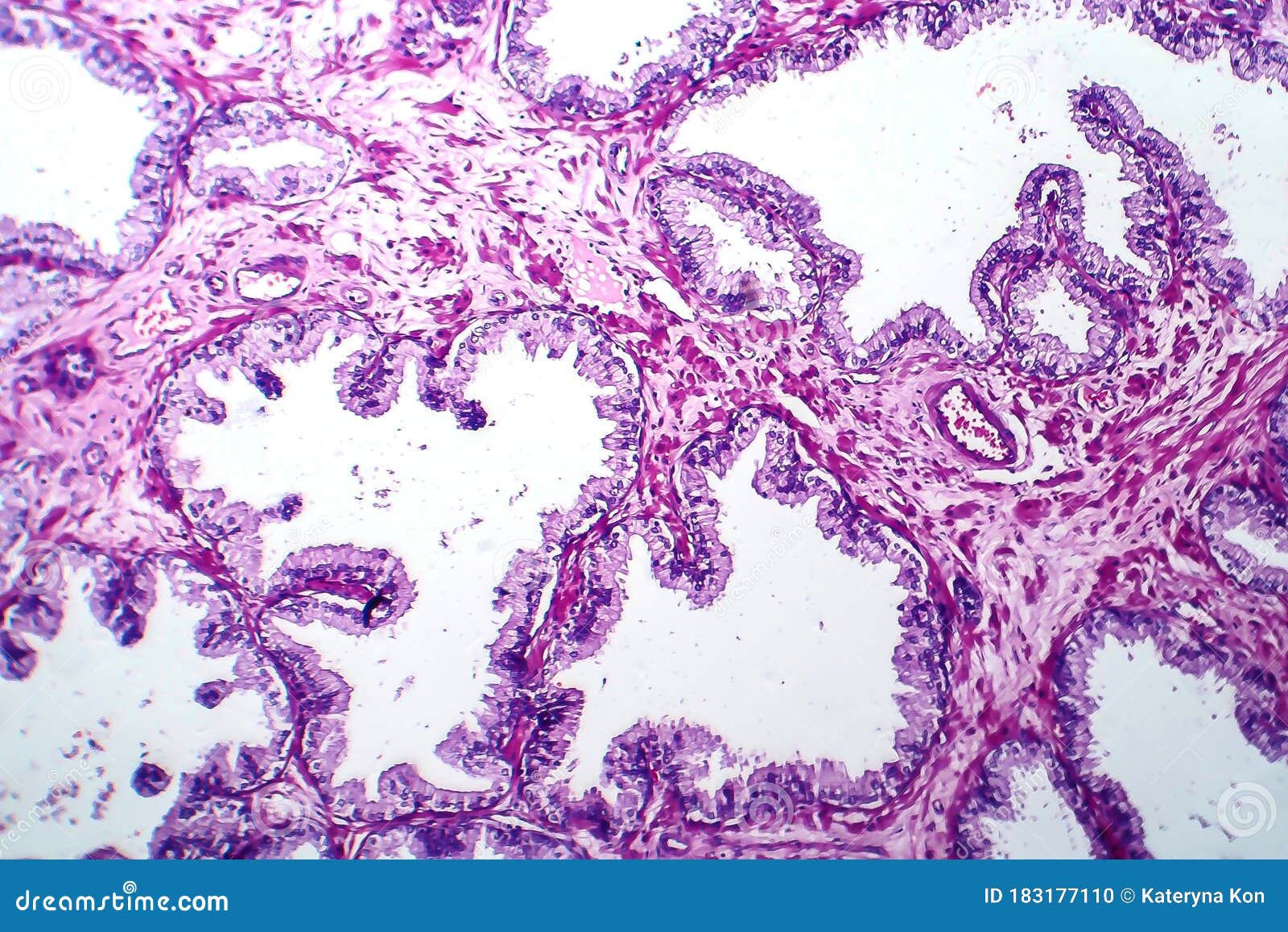 Prostate Cancer, Light Micrograph Stock Photo - Image of illness ...