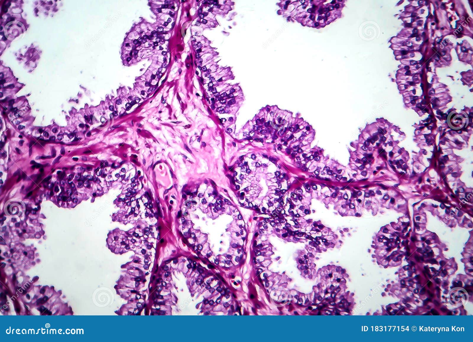 Prostate Cancer, Light Micrograph Stock Photo - Image of gland, cancer ...