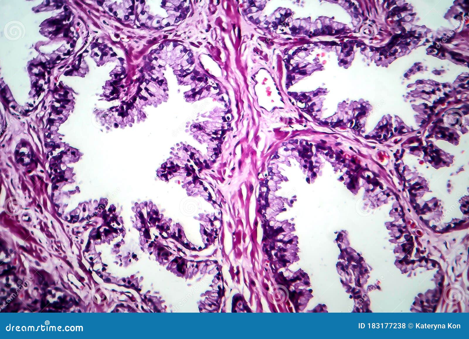 Prostate Cancer, Light Micrograph Stock Photo - Image of cancer ...