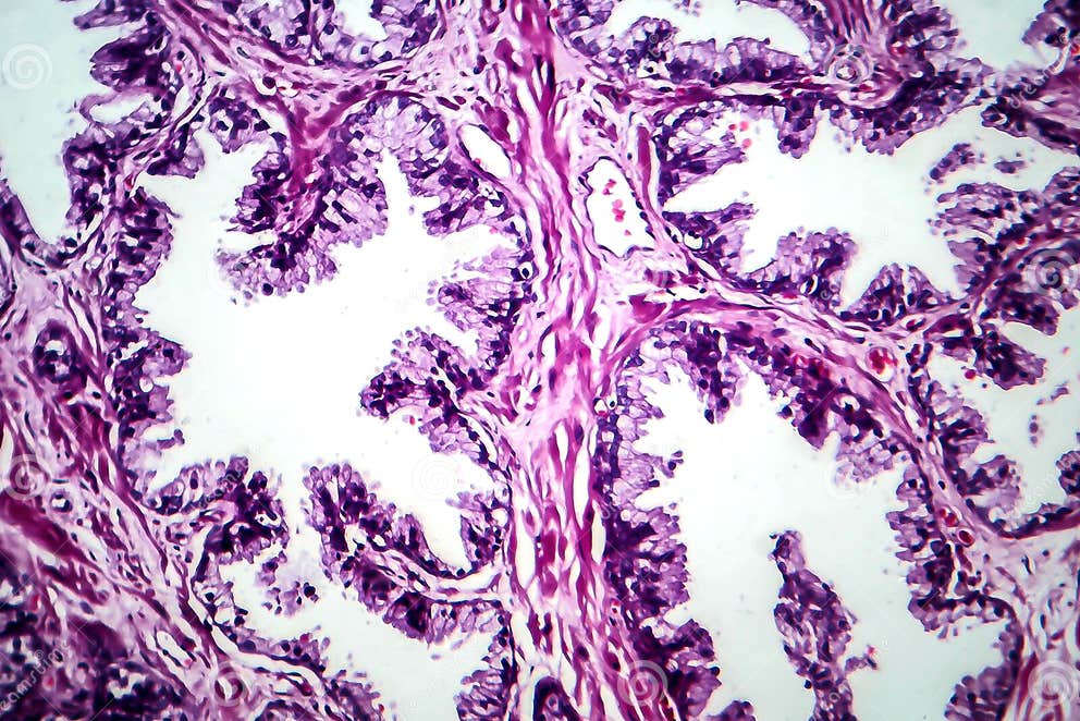 Prostate Cancer, Light Micrograph Stock Photo - Image of cancer ...