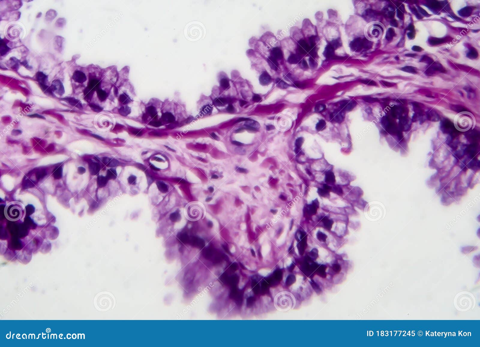 Prostate Cancer, Light Micrograph Stock Image - Image of magnification ...