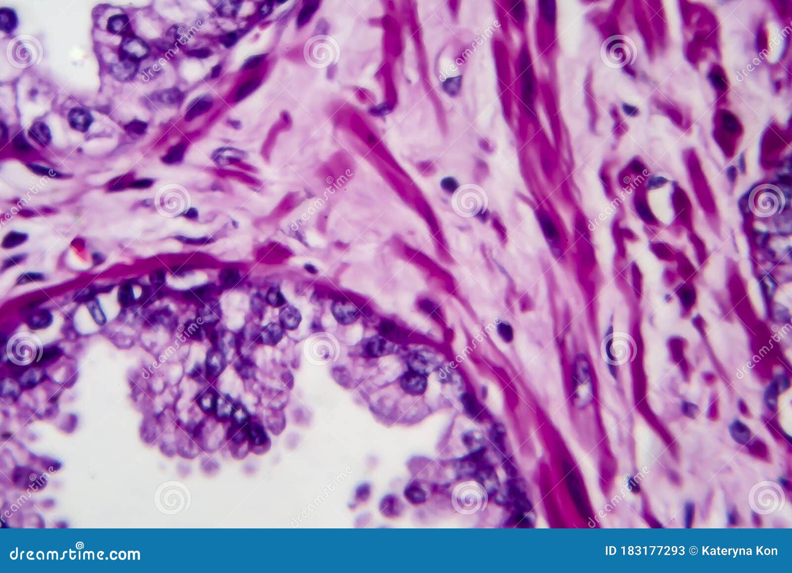 Prostate Cancer, Light Micrograph Stock Image - Image of morphological ...