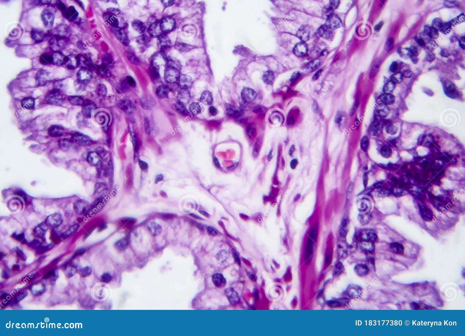 Prostate Cancer, Light Micrograph Stock Photo - Image of morphology ...