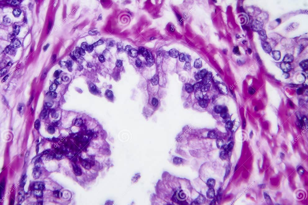 Prostate Cancer, Light Micrograph Stock Photo - Image of eosin ...