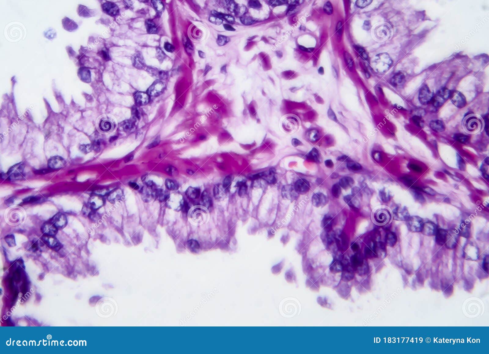 Prostate Cancer, Light Micrograph Stock Image - Image of disease ...