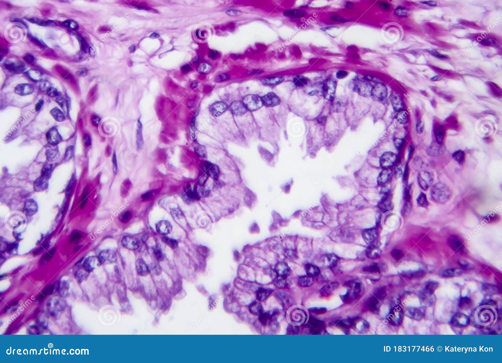 Prostate Cancer, Light Micrograph Stock Photo - Image of pathology ...