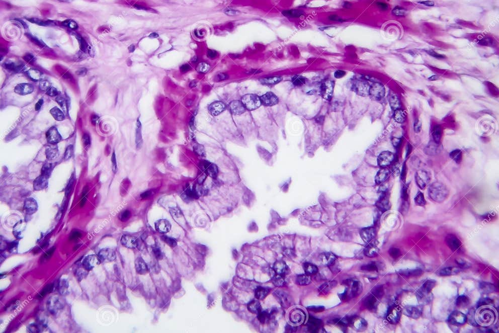 Prostate Cancer, Light Micrograph Stock Photo - Image of pathology ...