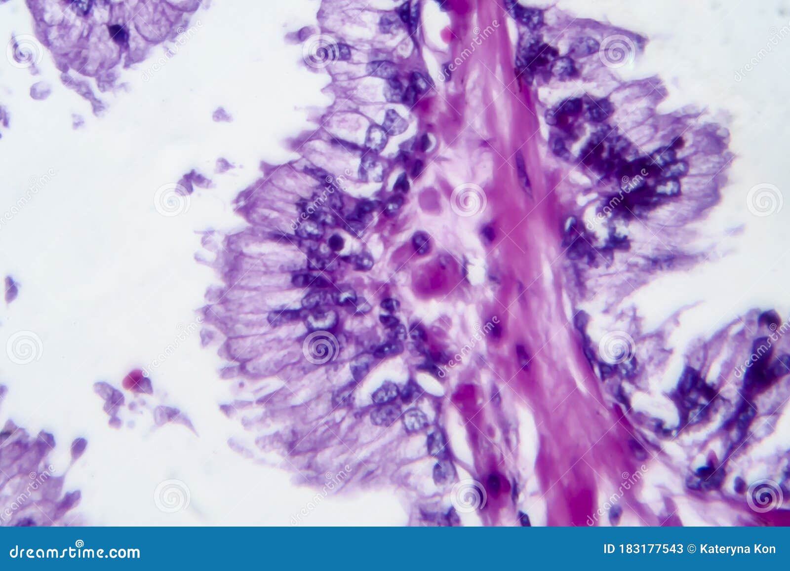 Prostate Cancer, Light Micrograph Stock Image - Image of morphology ...