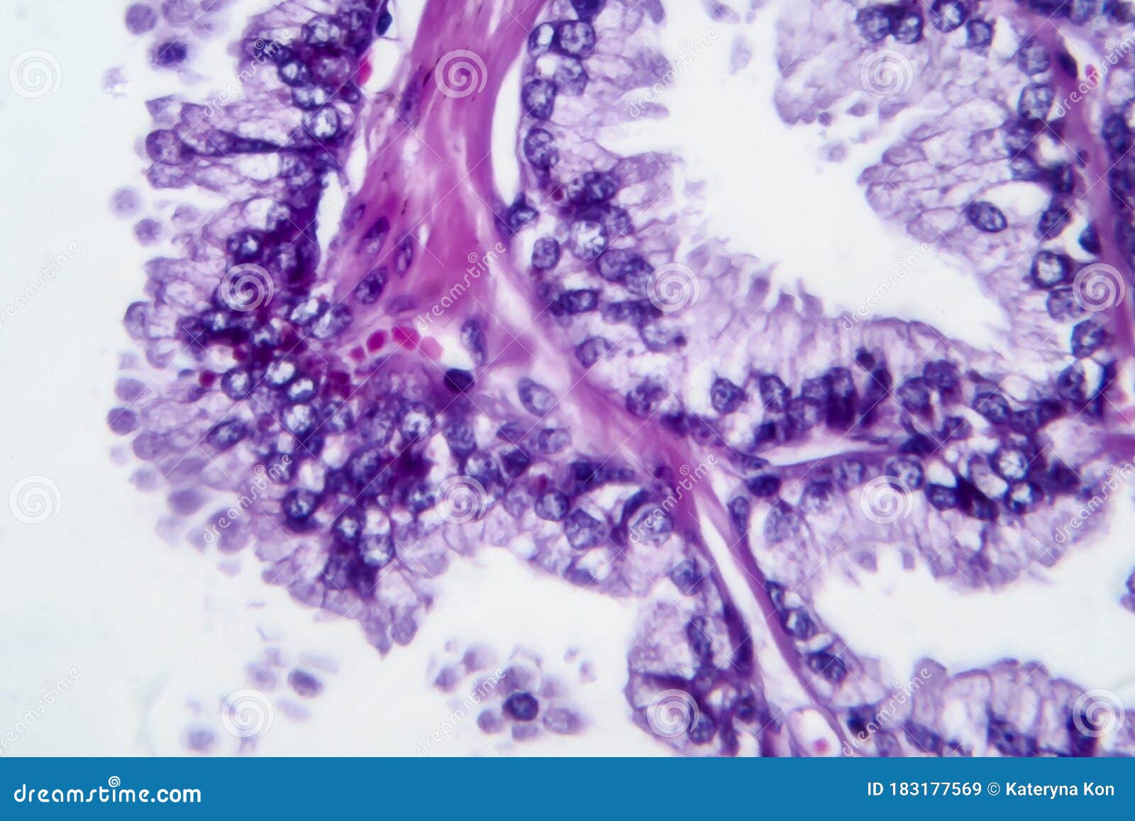 Prostate Cancer, Light Micrograph Stock Image - Image of microscope ...