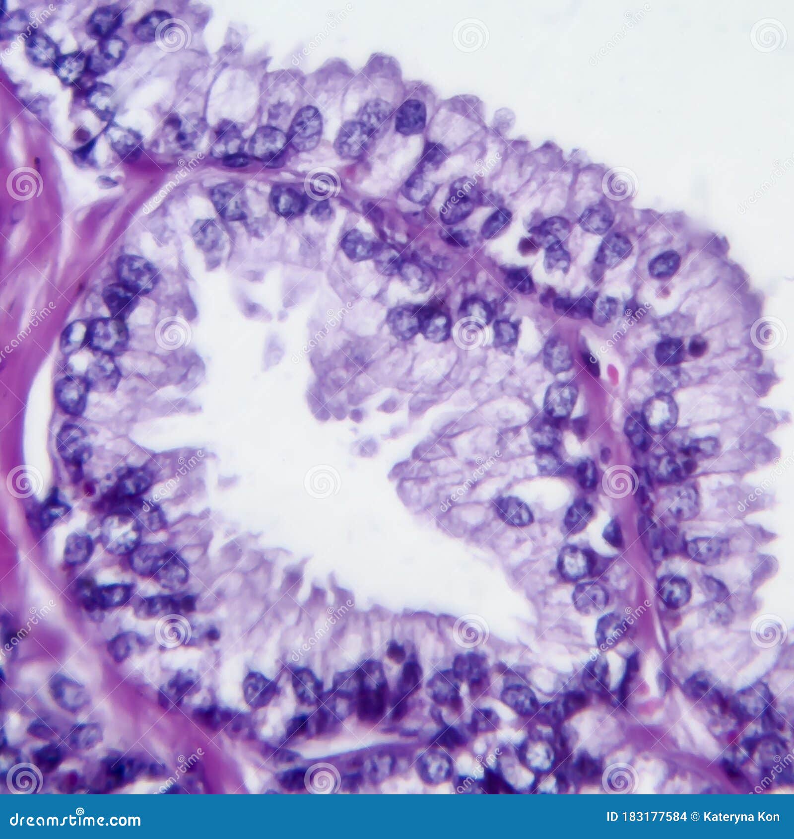 Prostate Cancer, Light Micrograph Stock Photo - Image of tissue ...