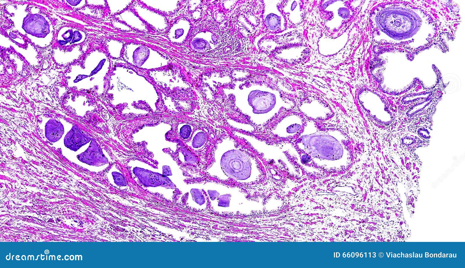 Prostate Hypertrofie Van Een Mens Stock Afbeelding - Image of micro ...