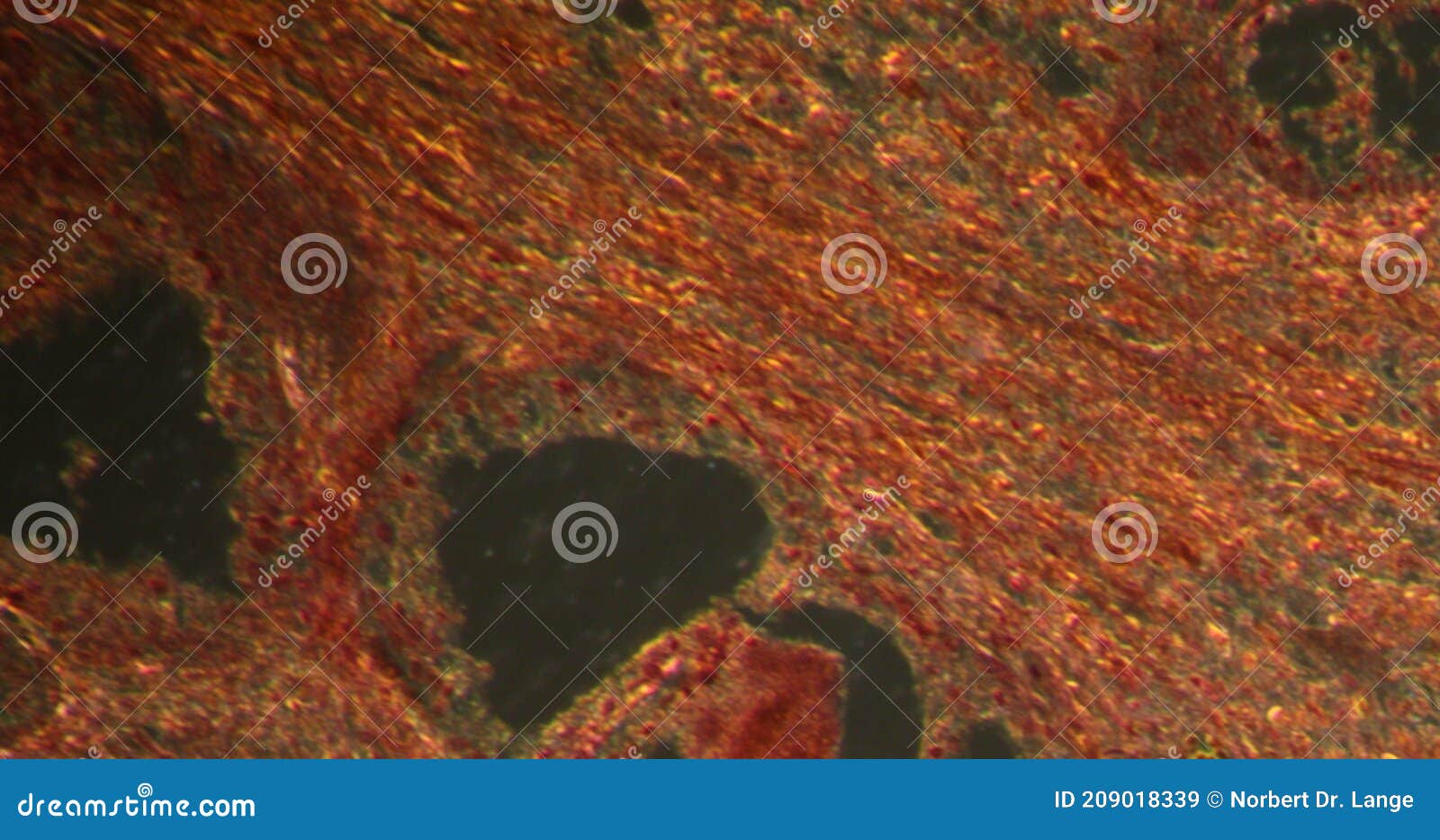 Prostate Hypertrophy in Darkfield Stock Video - Video of digestion ...