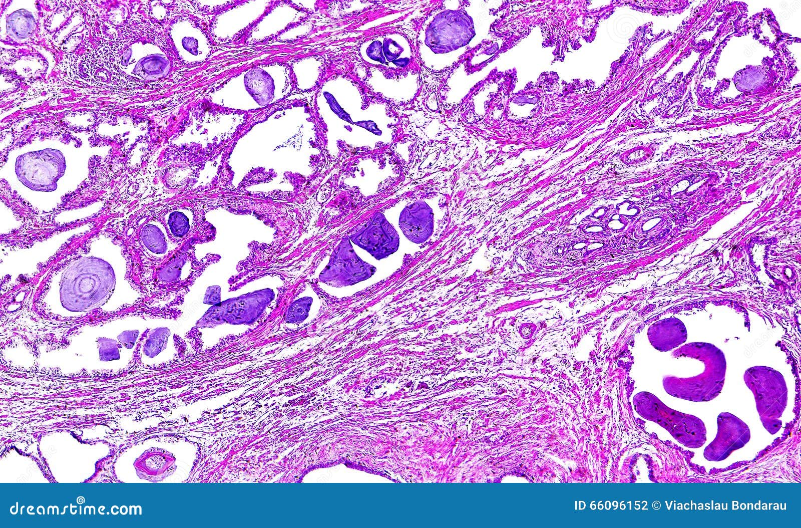 Prostate Hypertrophy of a Human Stock Photo - Image of hematoxylin ...
