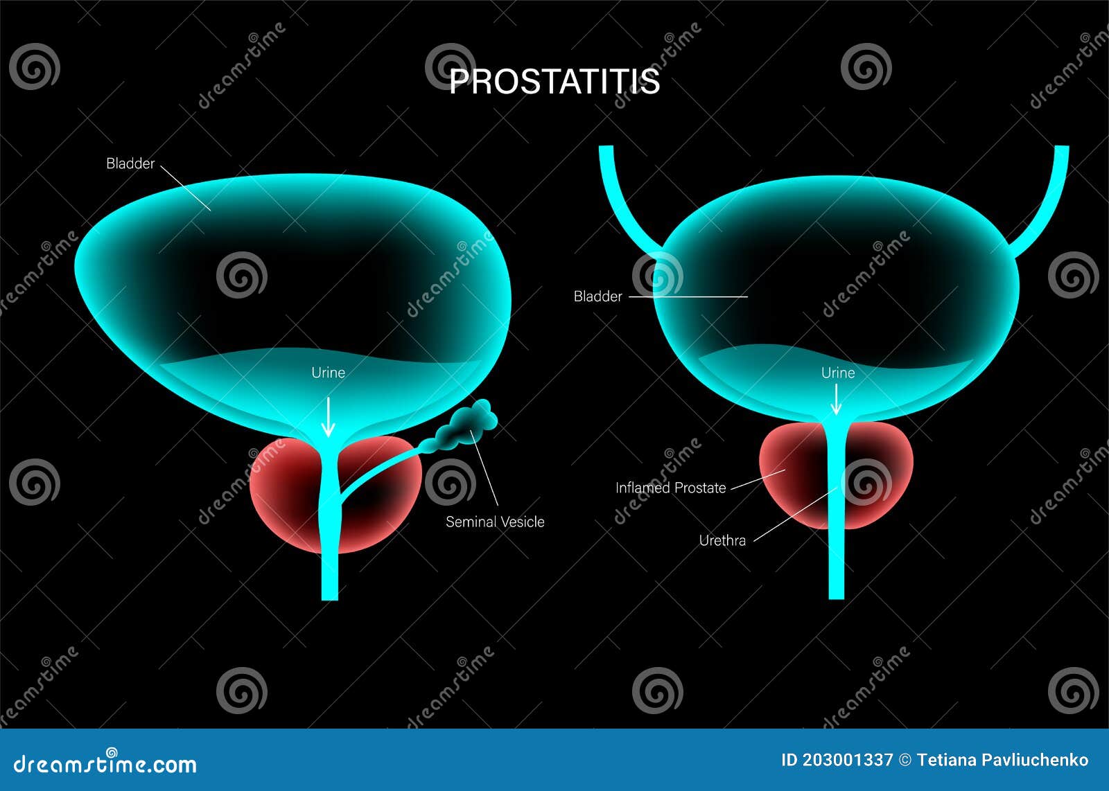Prostatitis Inflammation Problem Stock Vector - Illustration of anatomy ...