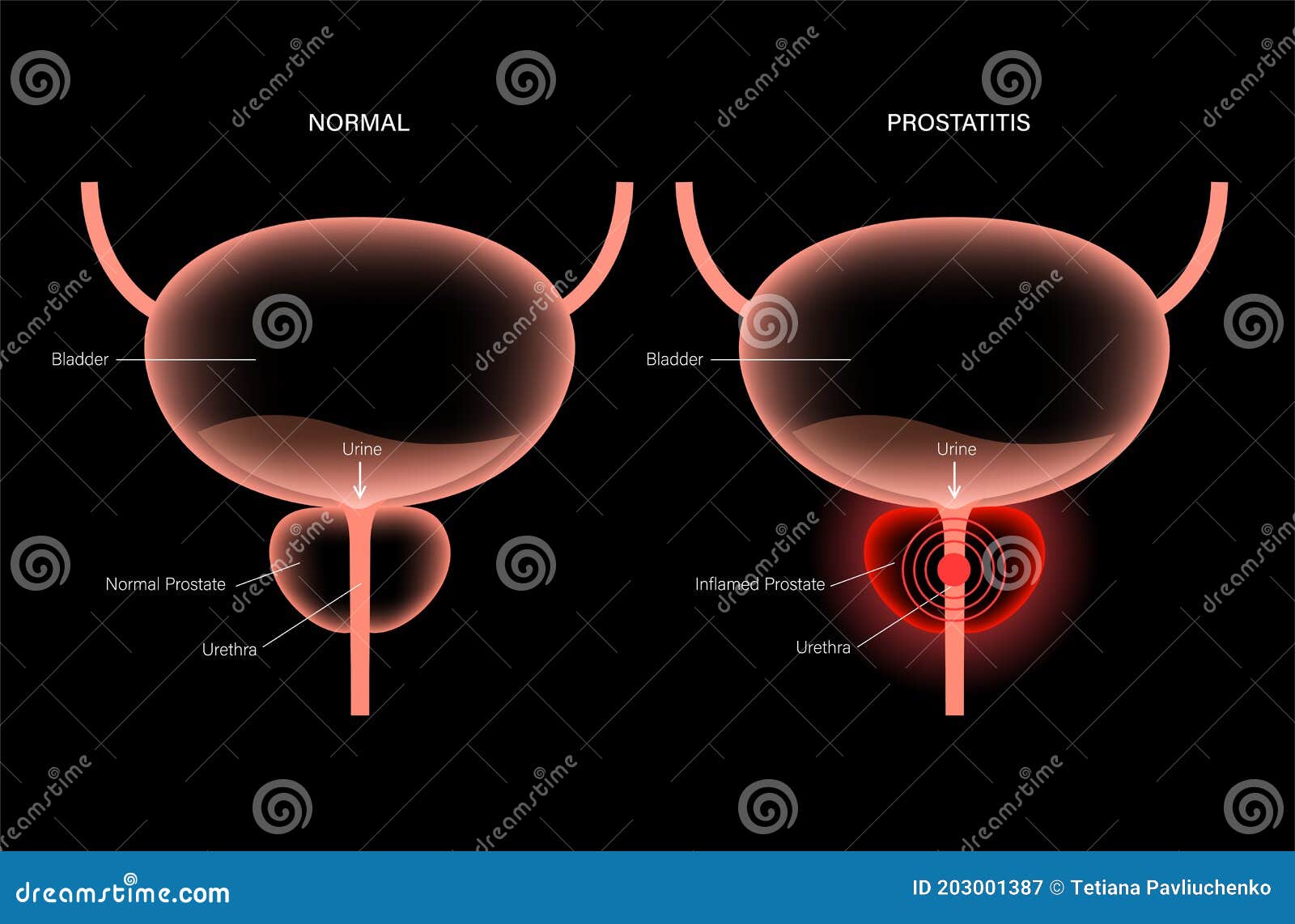 Prostatitis Inflammation Problem Stock Vector - Illustration of human ...