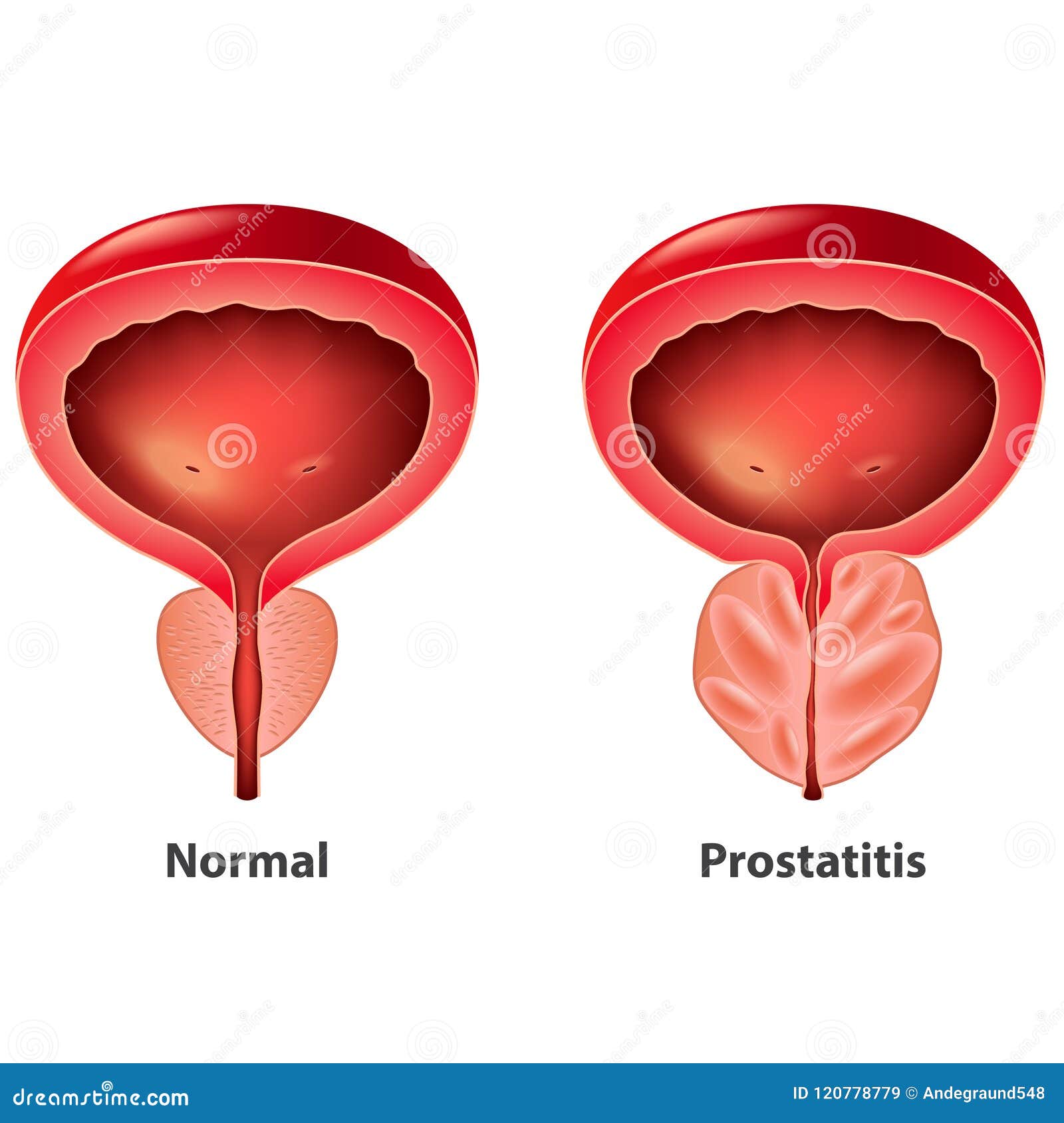 Prostatitis Normal And Inflamed Prostate Isolated Vector Stock Vector