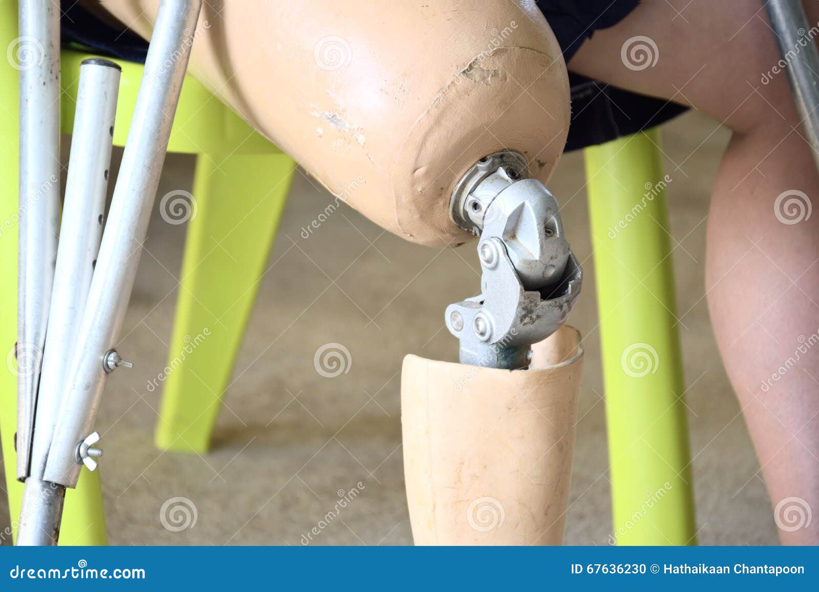 Prosthesis on right leg stock photo. Image of joint, prosthesis - 67636230