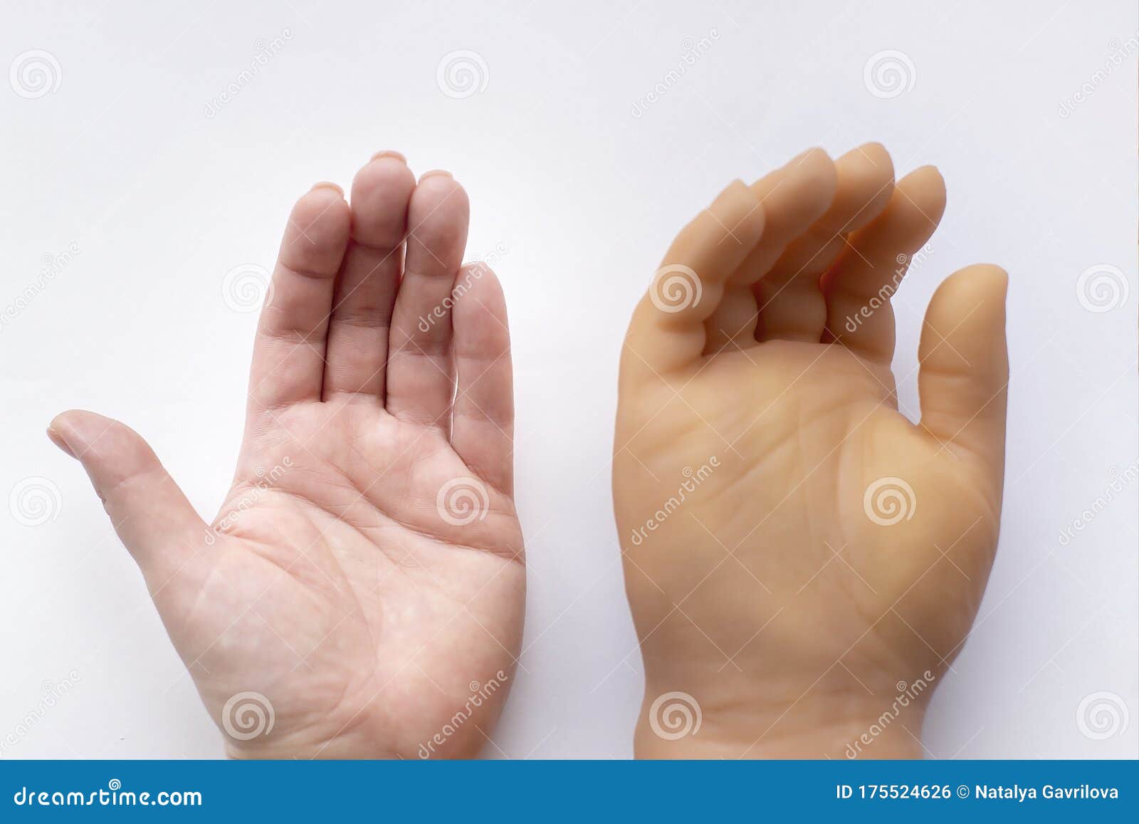 Prosthetic Hand and Live Hand Stock Photo - Image of amputation ...