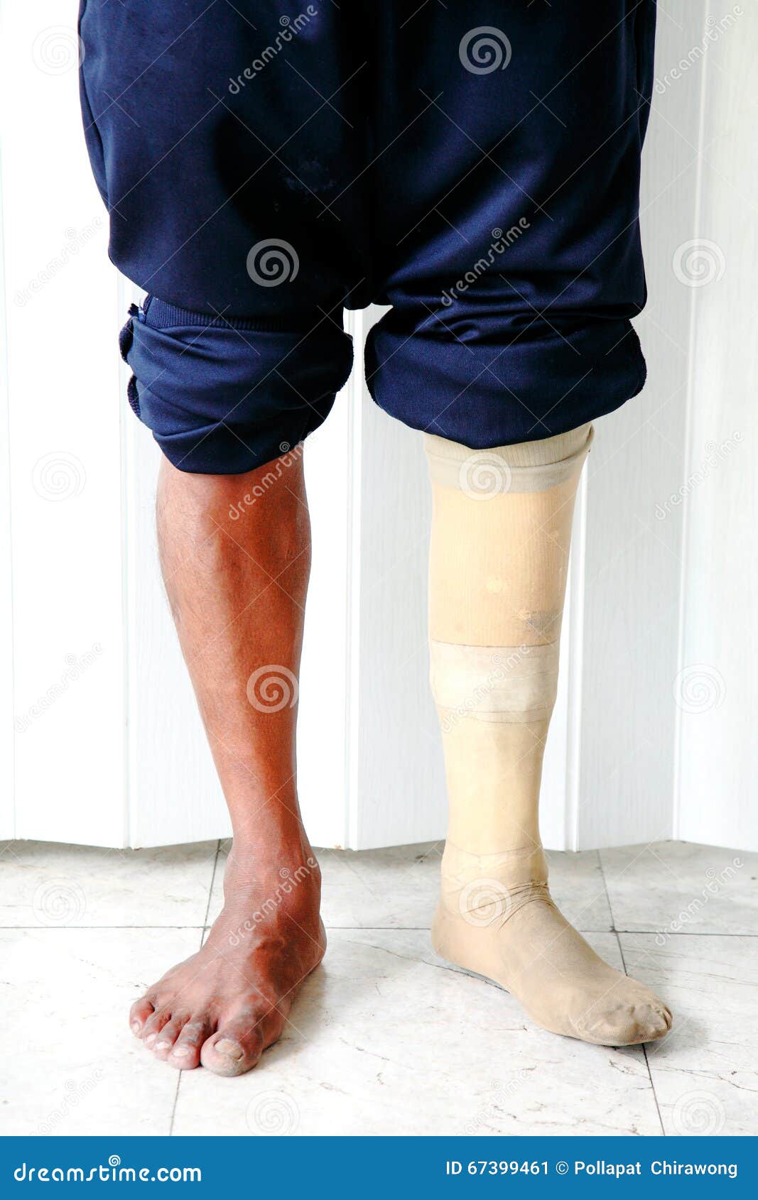 Prosthetic leg stock image. Image of healthcare, accident - 67399461