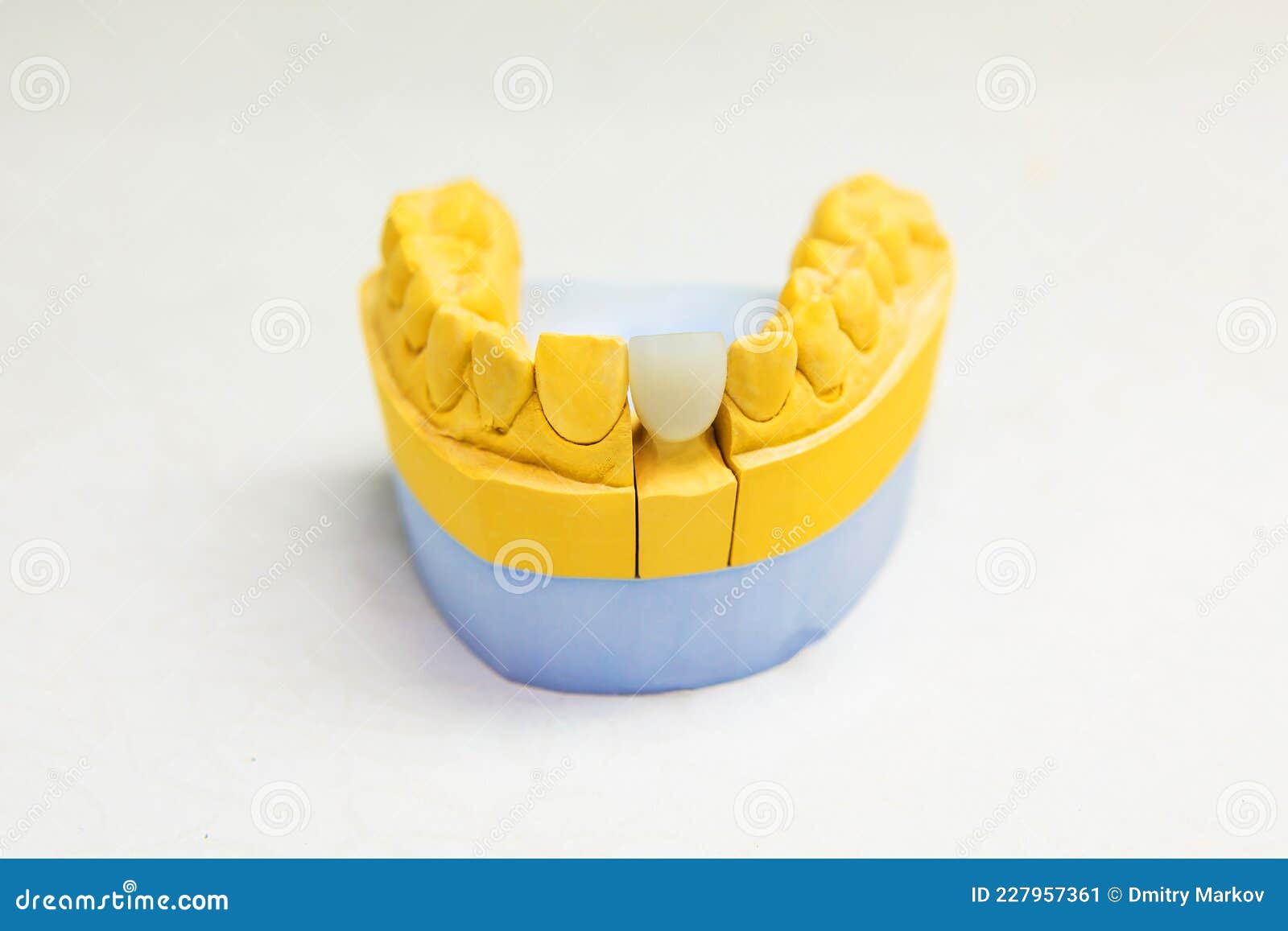 Prosthetic Teeth. Restoration of the Front Tooth Stock Image - Image of ...