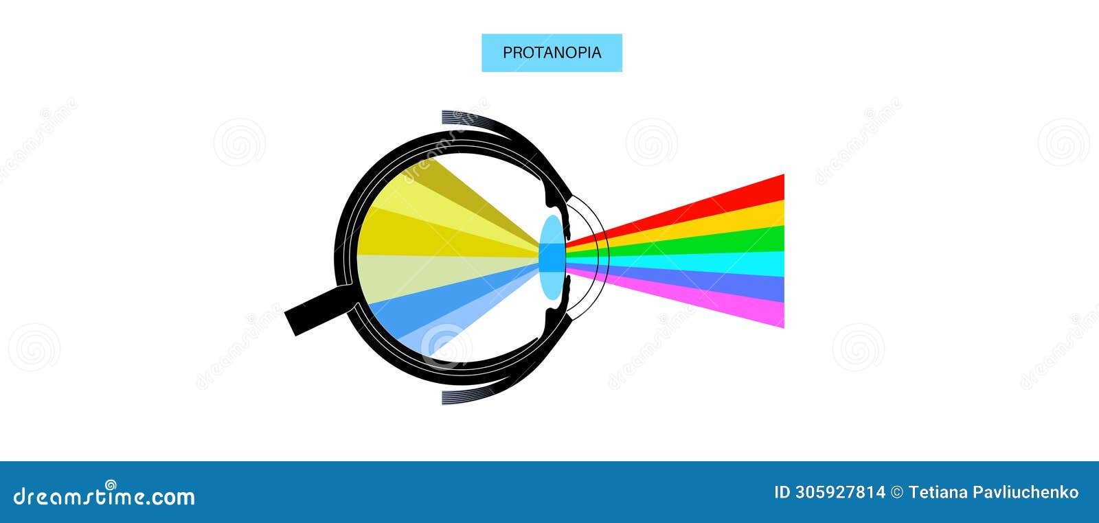 Protanomaly and protanopia stock vector. Illustration of plate - 305927814