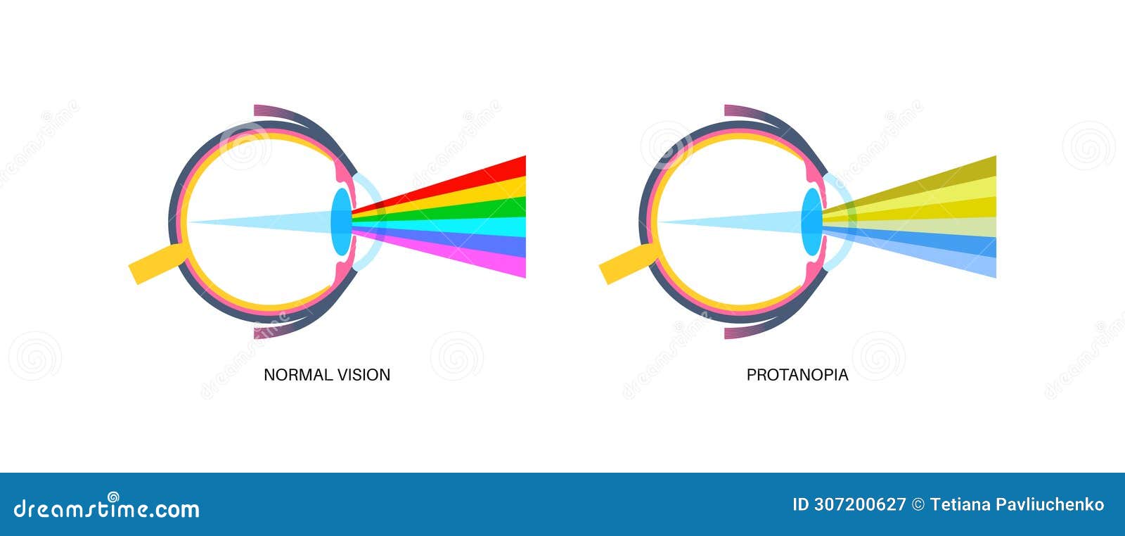 Protanomaly and protanopia stock vector. Illustration of spectrum ...