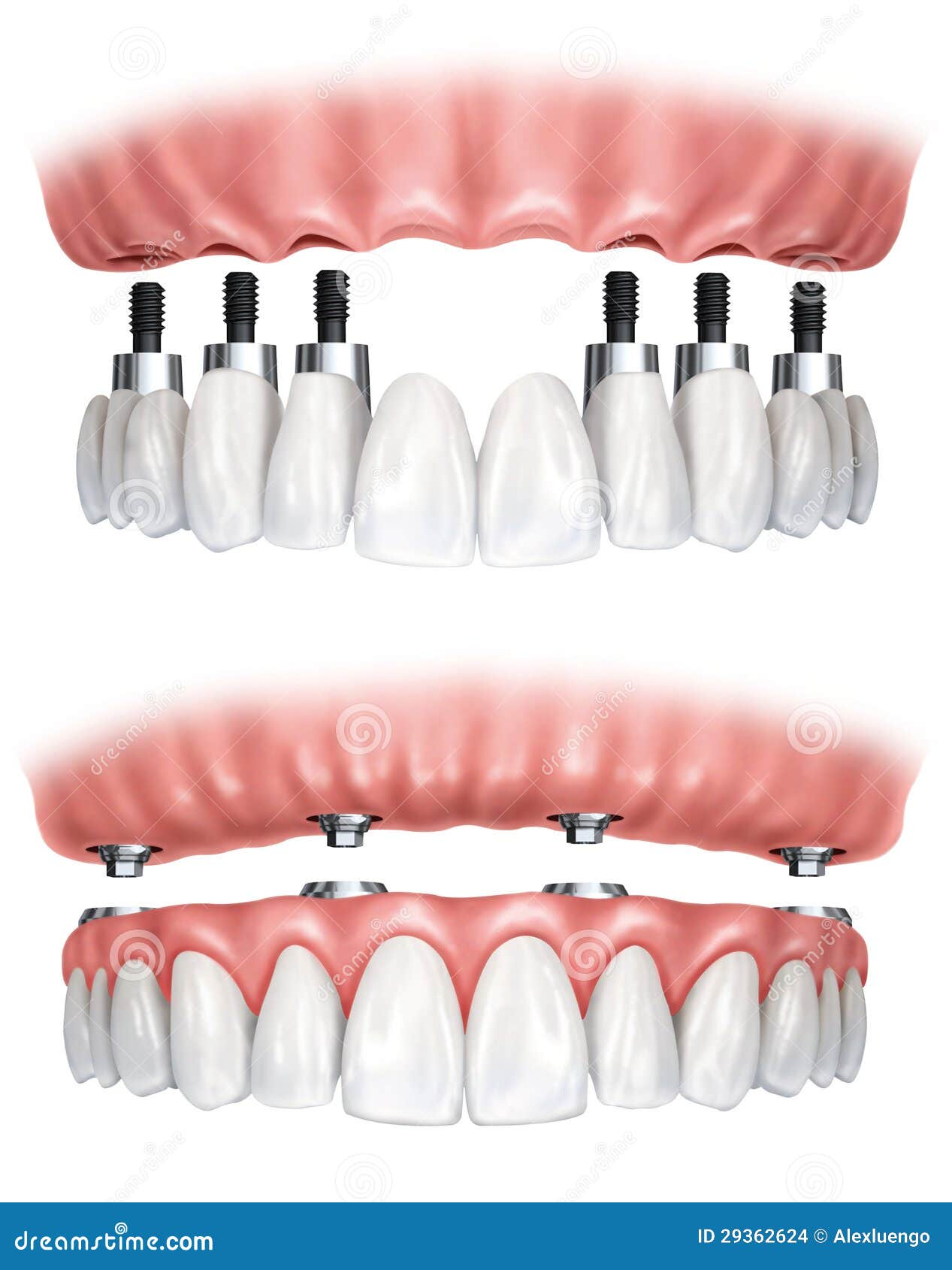 Protesi dentaria illustrazione di stock. Illustrazione di alimento ...