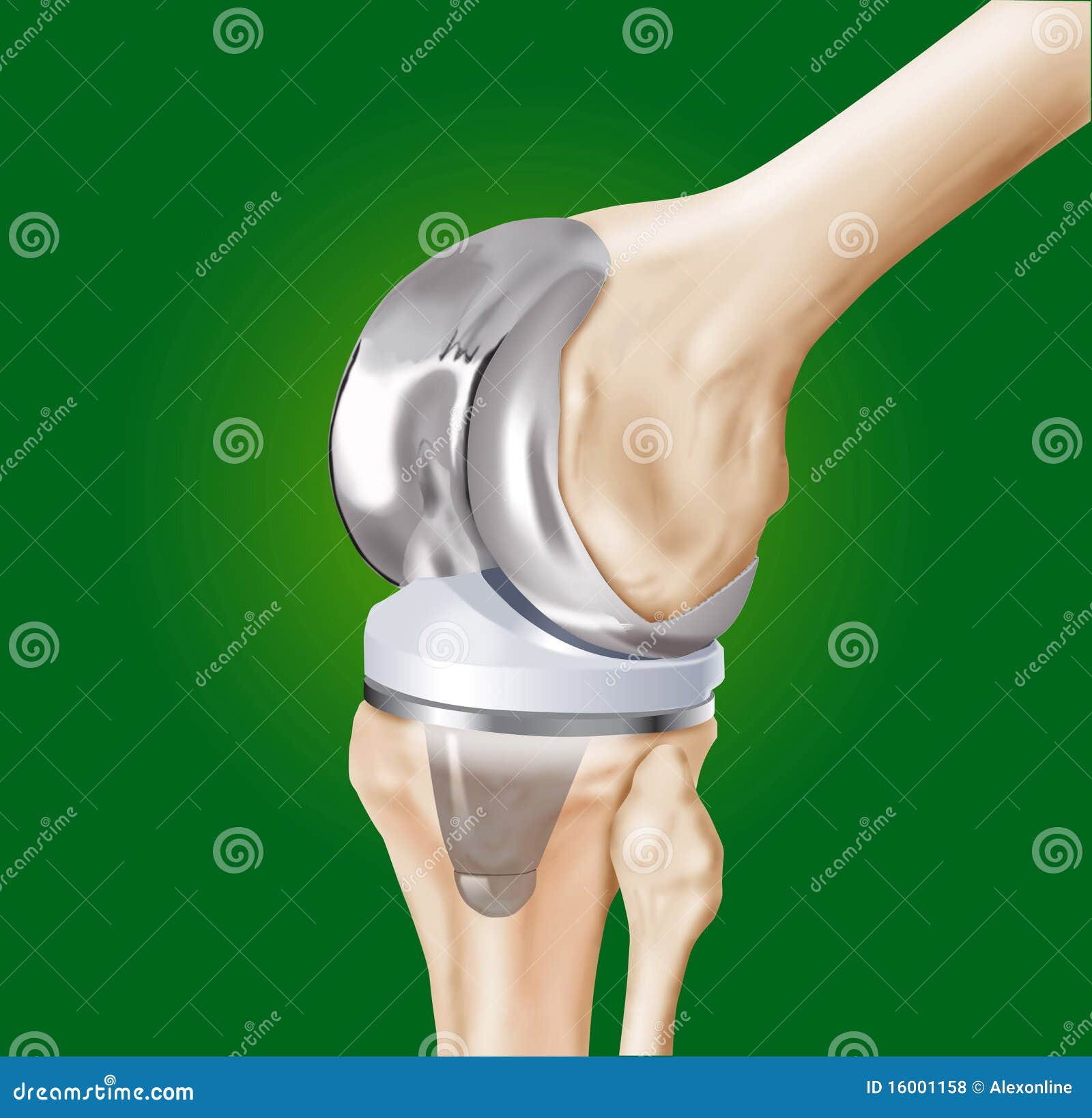 Prothèse Du Genou Chirurgical Photos libres de droits - Image: 16001158