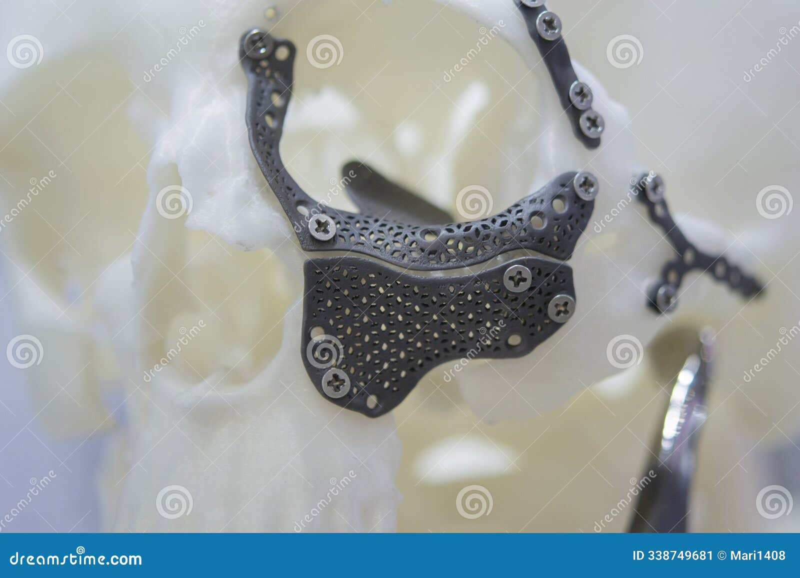 Prototype Human Skull from White Plastic Titanium Implants Form Plates ...