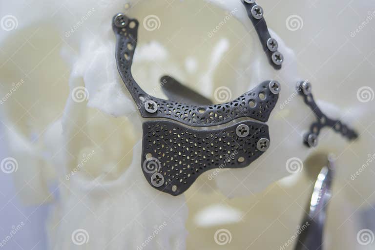 Prototype Human Skull from White Plastic Titanium Implants Form Plates ...