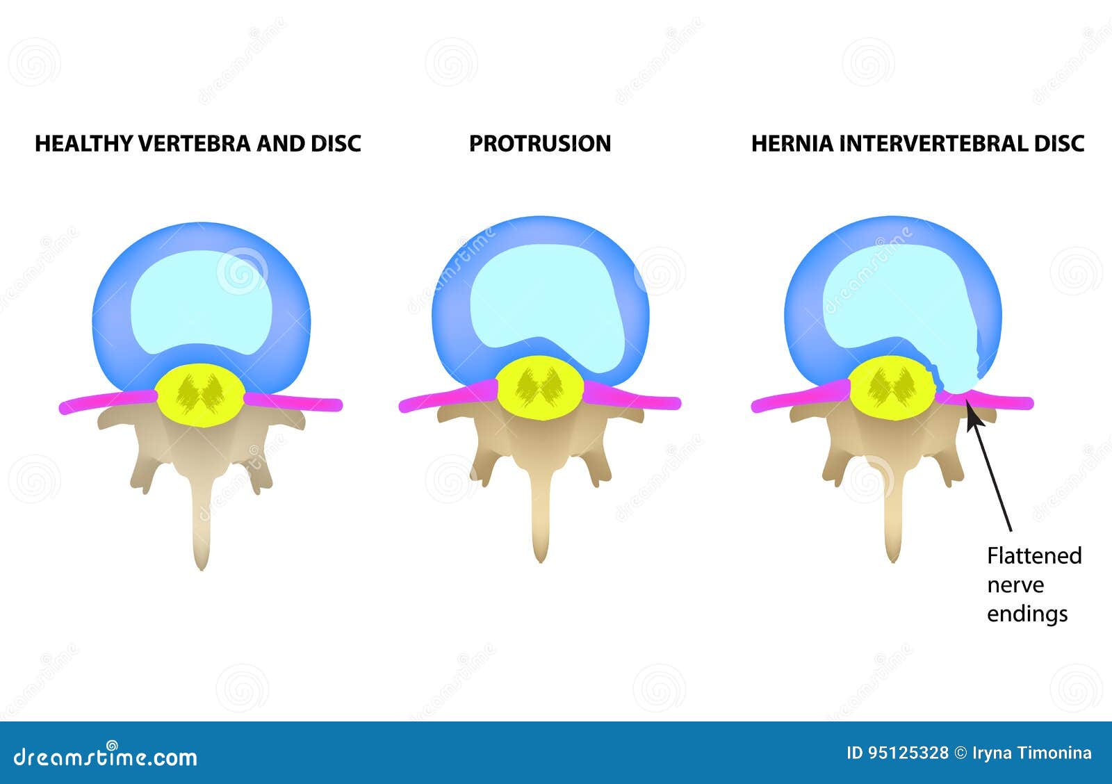 Protrusion Of The Intervertebral Disc. Hernia. Vector Illustration On ...