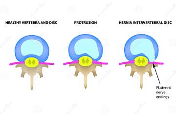 Protrusion of the Intervertebral Disc. Hernia. Vector Illustration on ...