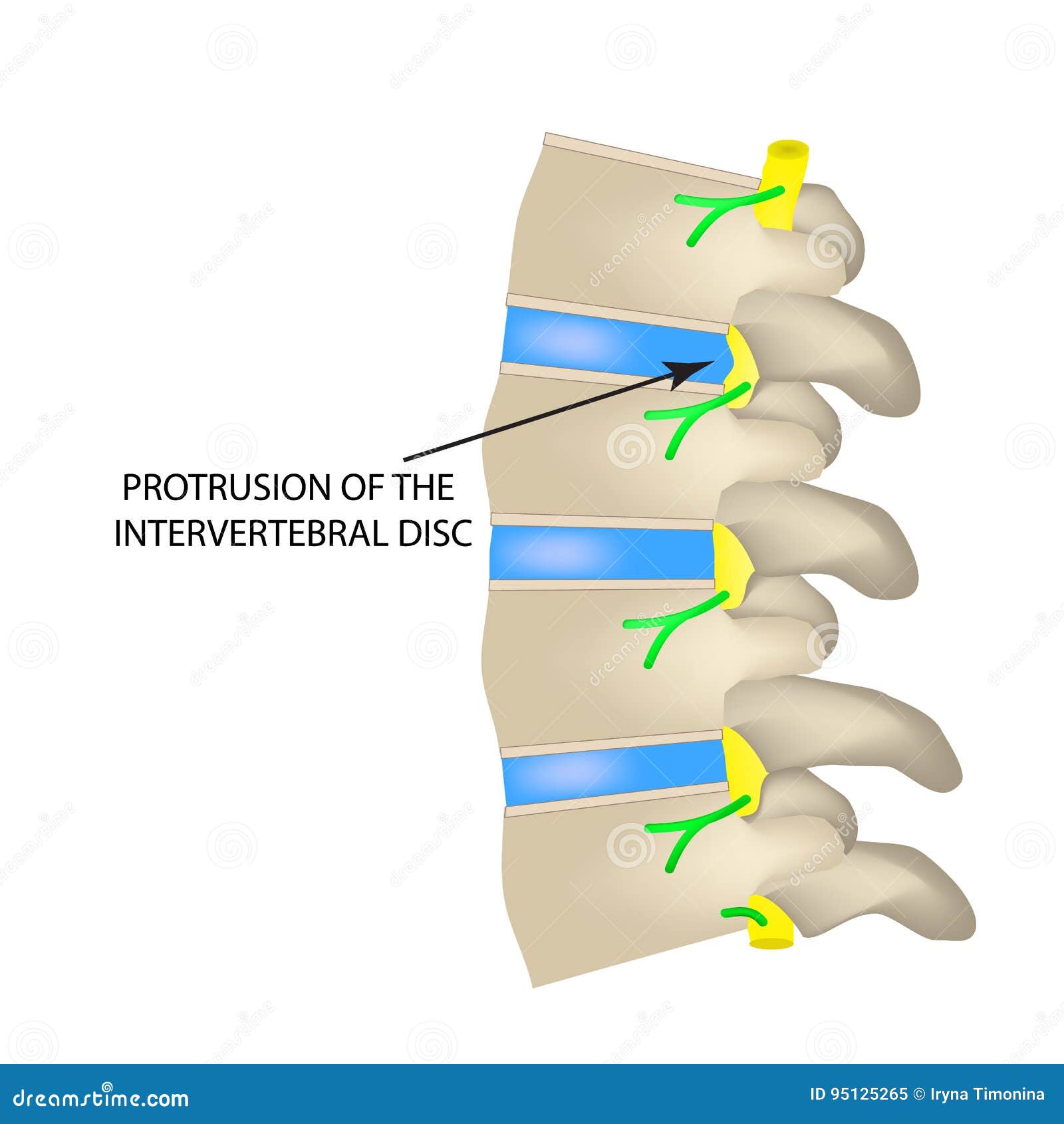 Disc Protrusion. Top View. Spine. Infographics. Vector Illustration On ...