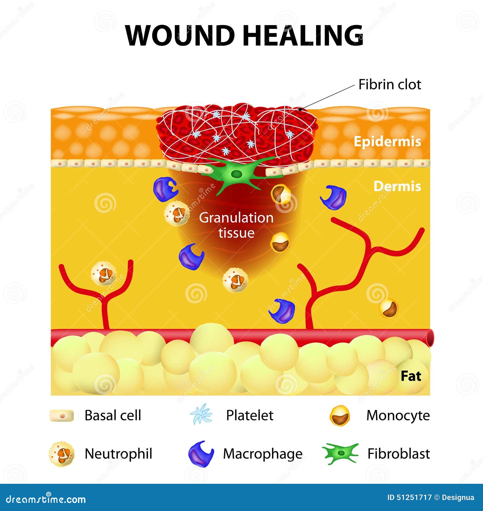 Prozess der Wundheilung vektor abbildung. Illustration von lymphozyte ...