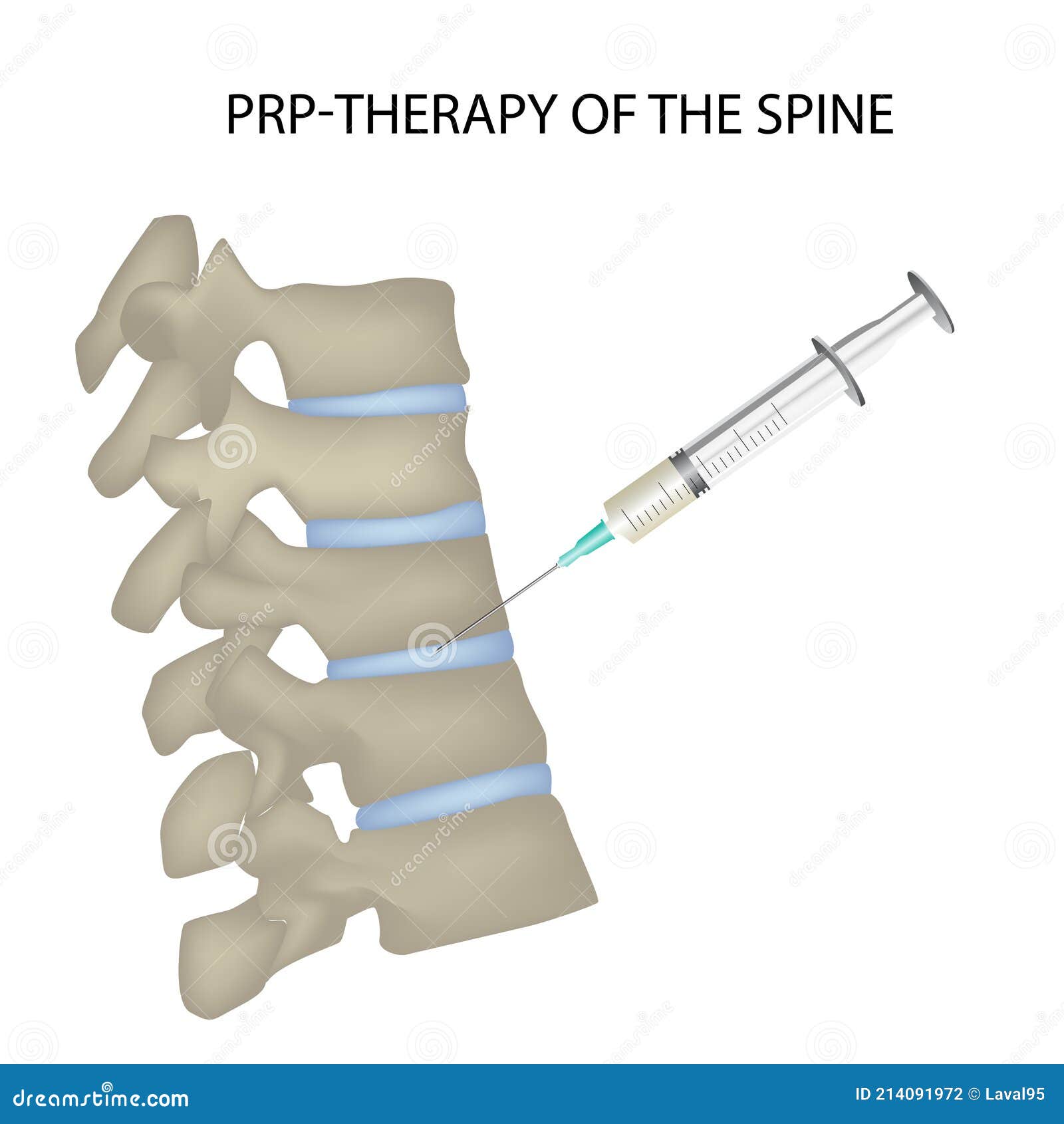PRP Spine Therapy, Vector Medical Illustration Stock Vector ...