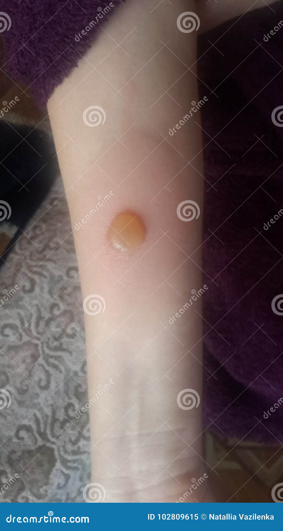 Prueba de tuberculina imagen de archivo. Imagen de tuberculosis - 102809615