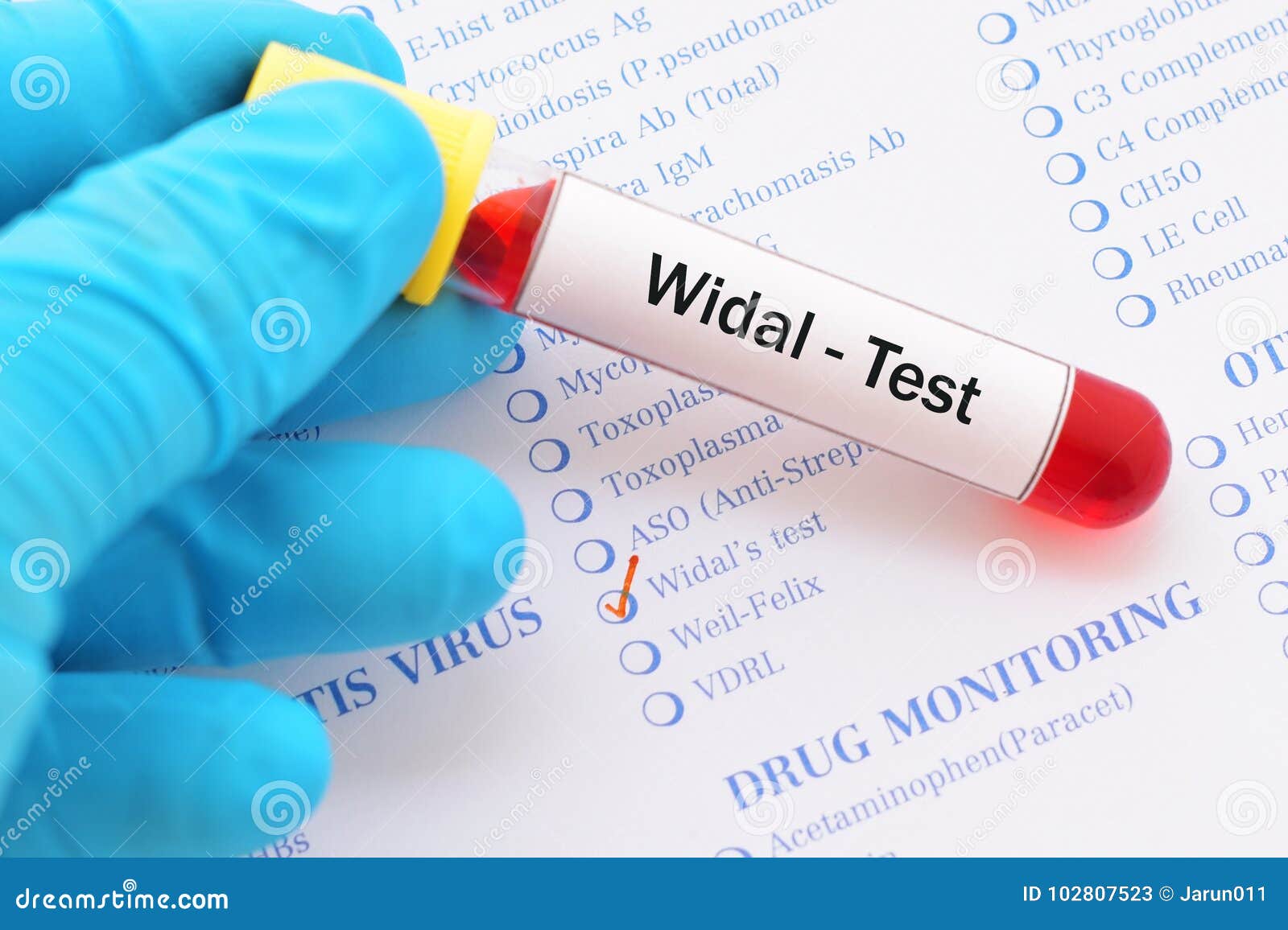 Prueba de Widal imagen de archivo. Imagen de felix, medicina - 102807523