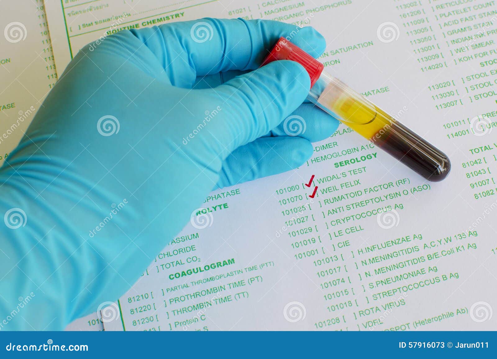 Prueba de Widal Weil Felix imagen de archivo. Imagen de sangre - 57916073