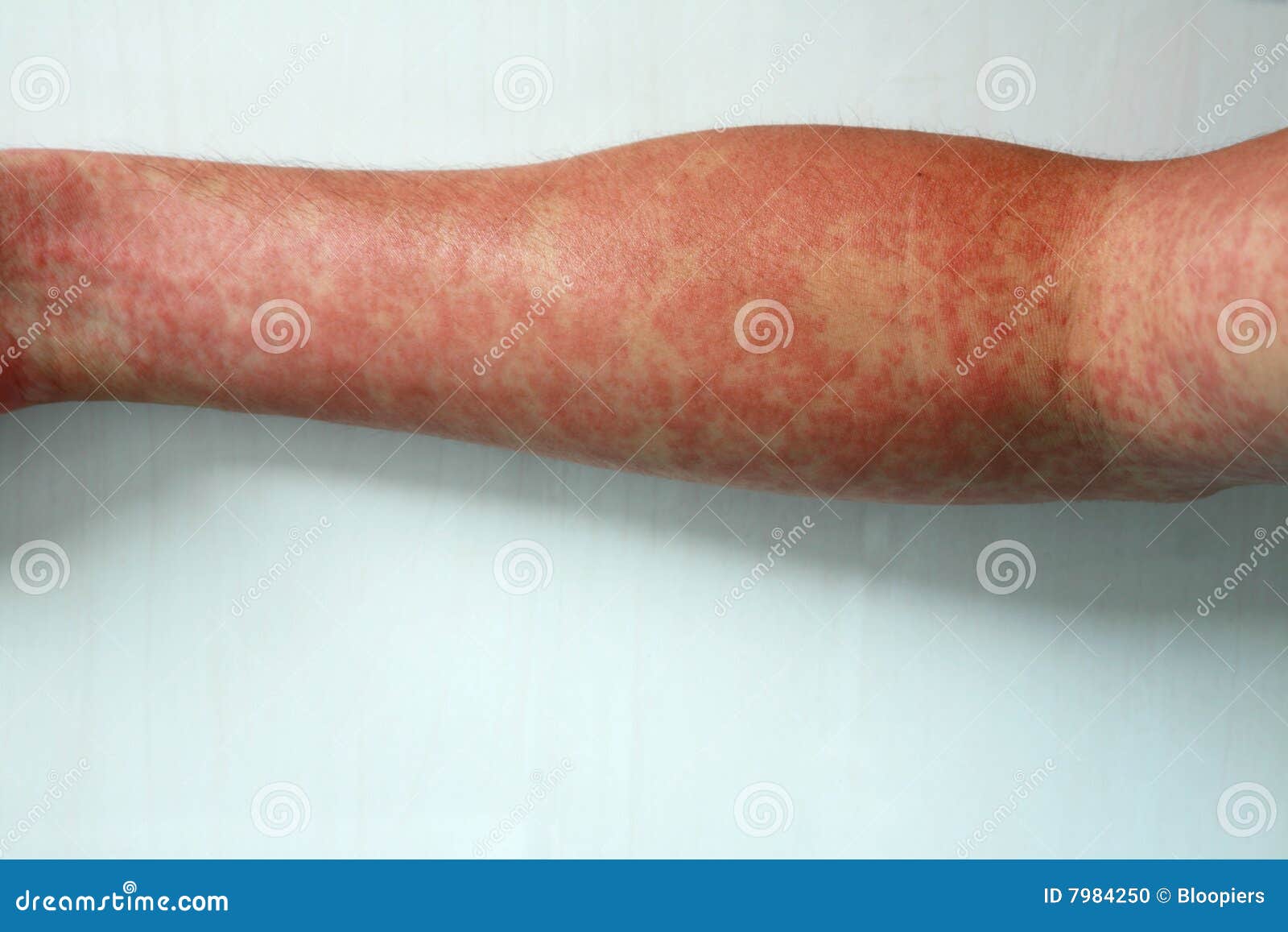 Prurido foto de stock. Imagem de dermatologia, hemorragia - 7984250