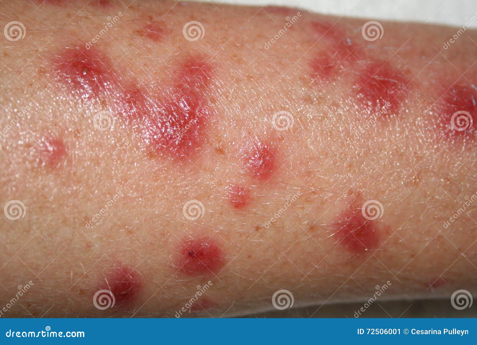 Prurido de pele feio imagem de stock. Imagem de vermelho - 72506001